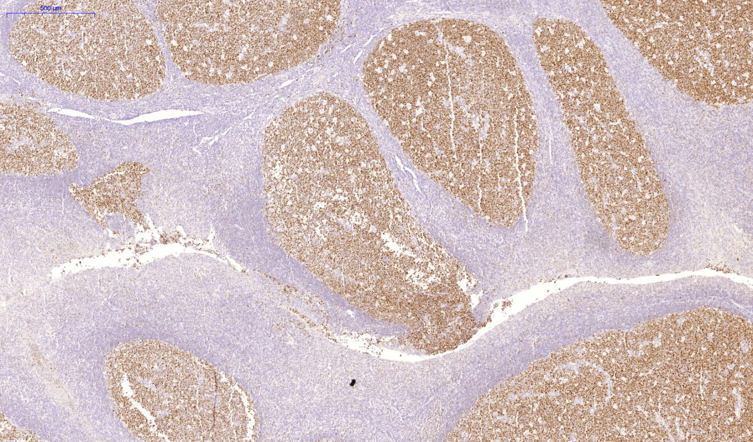 New antibody: Bcl-6 clone MX042